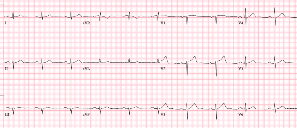 Lateral STEMI or Occlusion MI? | ECG cases | Emergency Medicine Cases