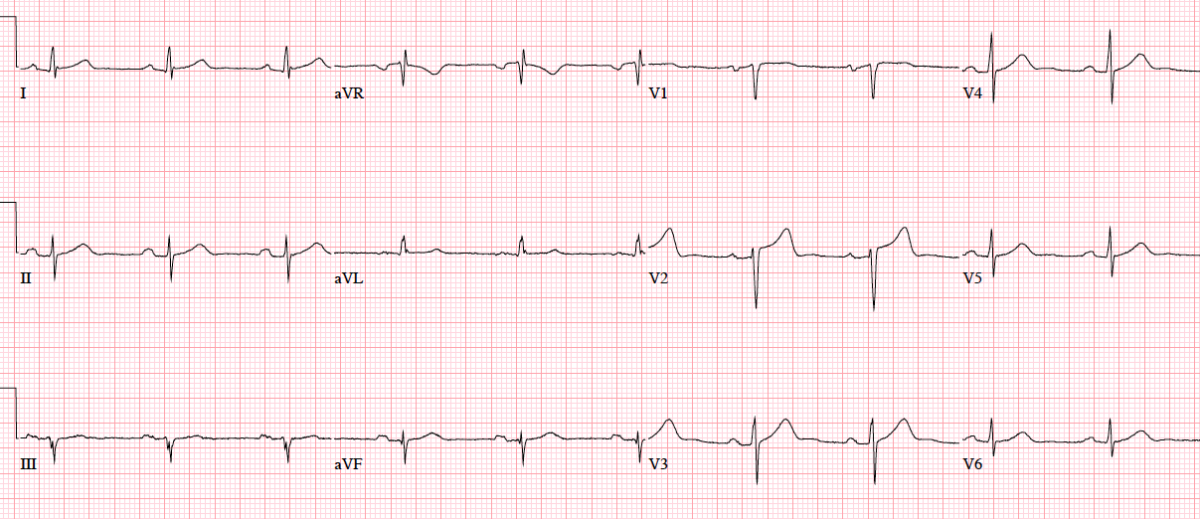Lateral STEMI or Occlusion MI? | ECG cases | Emergency Medicine Cases