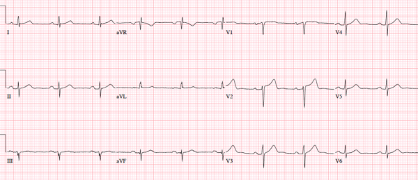 Lateral STEMI or Occlusion MI? | ECG cases | Emergency Medicine Cases