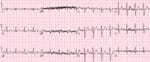 Lateral STEMI or Occlusion MI? | ECG cases | Emergency Medicine Cases