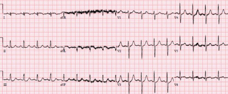 Lateral STEMI or Occlusion MI? | ECG cases | Emergency Medicine Cases