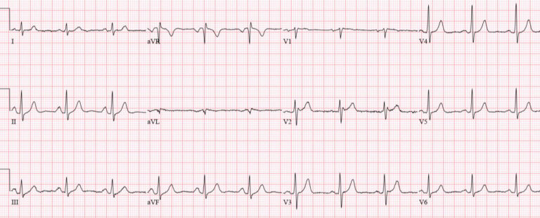 Lateral STEMI or Occlusion MI? | ECG cases | Emergency Medicine Cases