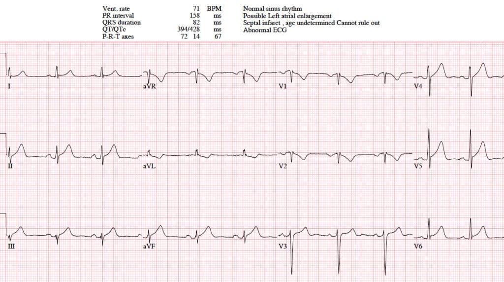 Lateral STEMI or Occlusion MI? | ECG cases | Emergency Medicine Cases