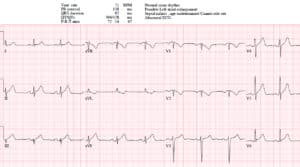 Lateral STEMI or Occlusion MI? | ECG cases | Emergency Medicine Cases