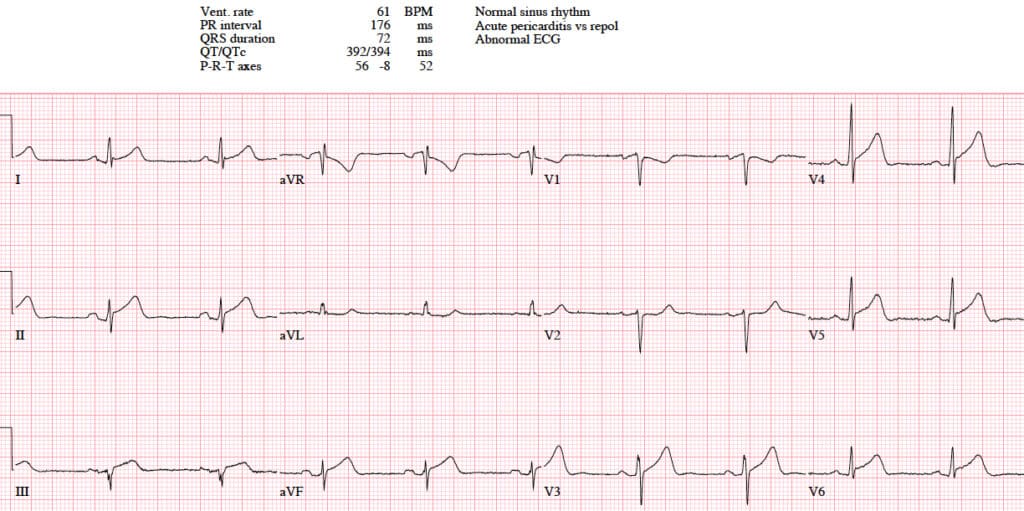 Lateral STEMI or Occlusion MI? | ECG cases | Emergency Medicine Cases