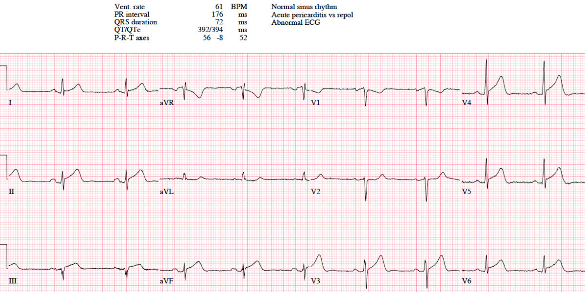 Lateral STEMI or Occlusion MI? | ECG cases | Emergency Medicine Cases
