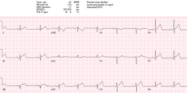 Lateral STEMI or Occlusion MI? | ECG cases | Emergency Medicine Cases