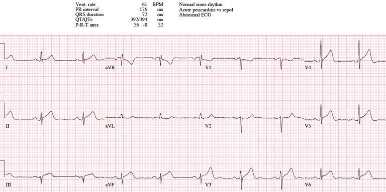 Lateral STEMI or Occlusion MI? | ECG cases | Emergency Medicine Cases