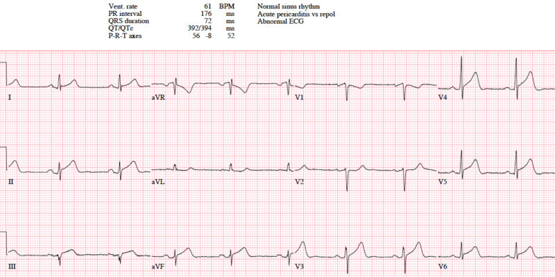 Lateral STEMI or Occlusion MI? | ECG cases | Emergency Medicine Cases
