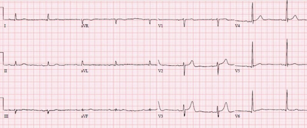 Lateral STEMI or Occlusion MI? | ECG cases | Emergency Medicine Cases