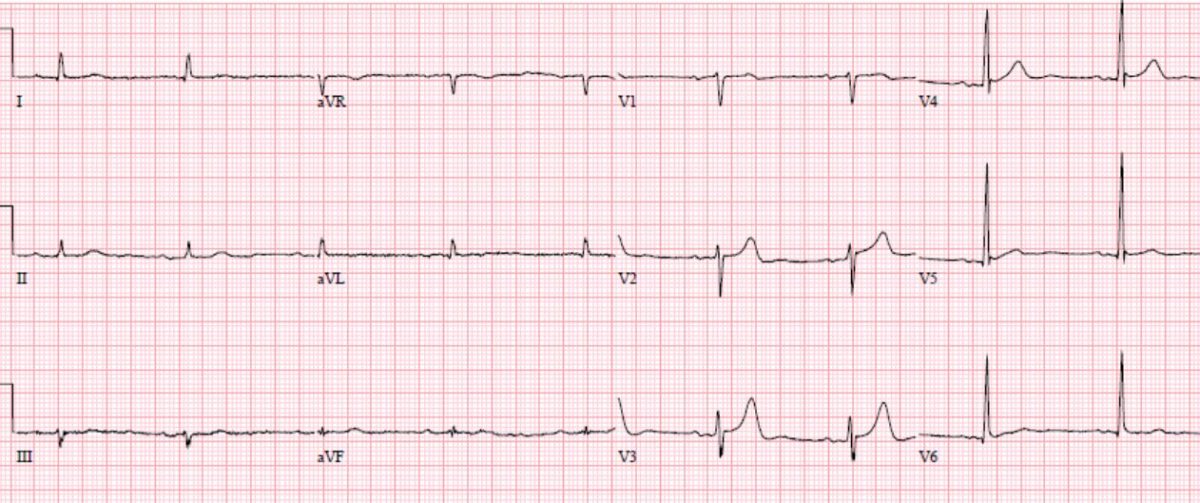 Lateral STEMI or Occlusion MI? | ECG cases | Emergency Medicine Cases