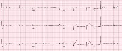 Lateral STEMI or Occlusion MI? | ECG cases | Emergency Medicine Cases
