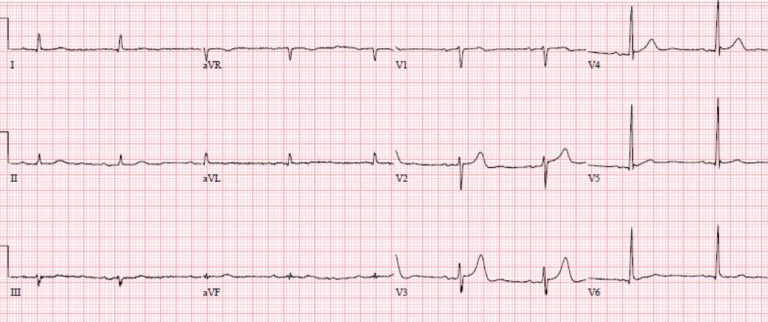Lateral STEMI or Occlusion MI? | ECG cases | Emergency Medicine Cases