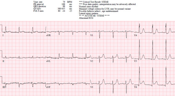 Lateral STEMI or Occlusion MI? | ECG cases | Emergency Medicine Cases