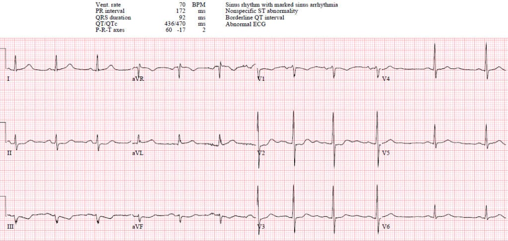 Lateral STEMI or Occlusion MI? | ECG cases | Emergency Medicine Cases