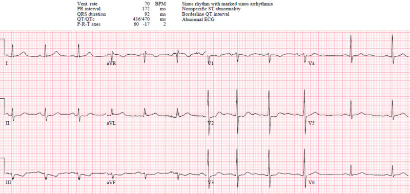 Lateral STEMI or Occlusion MI? | ECG cases | Emergency Medicine Cases