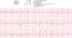 Lateral STEMI or Occlusion MI? | ECG cases | Emergency Medicine Cases