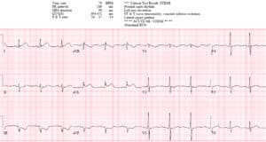 Lateral STEMI or Occlusion MI? | ECG cases | Emergency Medicine Cases