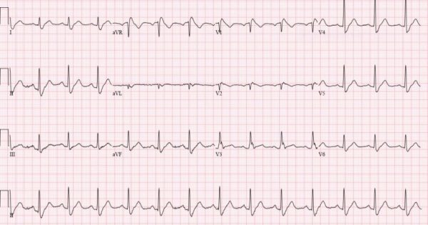 Cardiac syncope ECG Interpretation | ECG cases | EM Cases