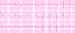 ST elevation in aVR, STEMI equivalent? | ECG Cases| Emergency Medicine ...