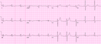 ST elevation in aVR, STEMI equivalent? | ECG Cases| Emergency Medicine ...