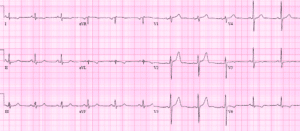 ST elevation in aVR, STEMI equivalent? | ECG Cases| Emergency Medicine ...