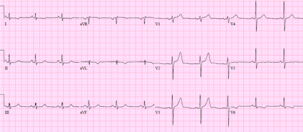 ST elevation in aVR, STEMI equivalent? | ECG Cases| Emergency Medicine ...