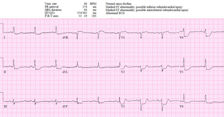 ST elevation in aVR, STEMI equivalent? | ECG Cases| Emergency Medicine ...