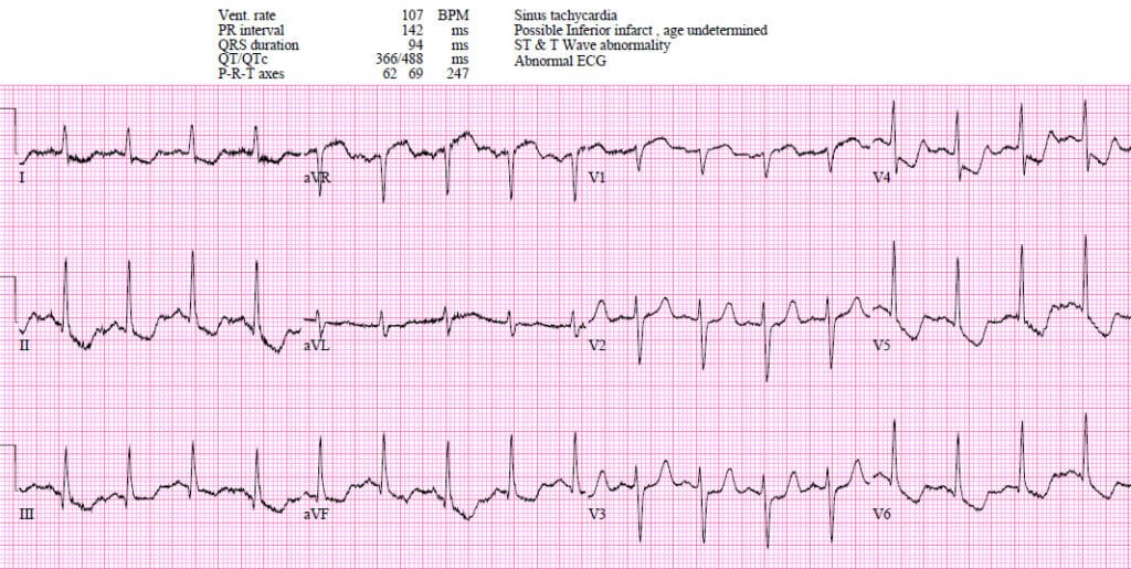 ST elevation in aVR, STEMI equivalent? | ECG Cases| Emergency Medicine ...