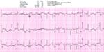 ST elevation in aVR, STEMI equivalent? | ECG Cases| Emergency Medicine ...