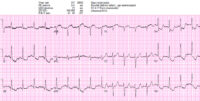 ST elevation in aVR, STEMI equivalent? | ECG Cases| Emergency Medicine ...