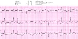 ST elevation in aVR, STEMI equivalent? | ECG Cases| Emergency Medicine ...