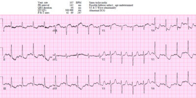 ST elevation in aVR, STEMI equivalent? | ECG Cases| Emergency Medicine ...