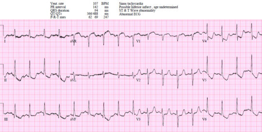 ST elevation in aVR, STEMI equivalent? | ECG Cases| Emergency Medicine ...