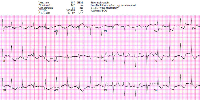 ST elevation in aVR, STEMI equivalent? | ECG Cases| Emergency Medicine ...