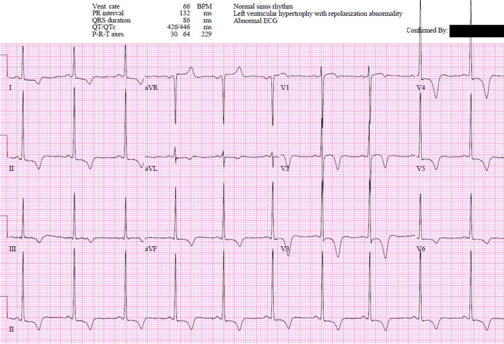 ST elevation in aVR, STEMI equivalent? | ECG Cases| Emergency Medicine ...
