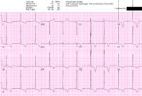 ST elevation in aVR, STEMI equivalent? | ECG Cases| Emergency Medicine ...