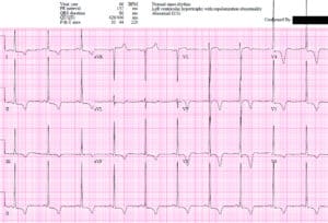 ST elevation in aVR, STEMI equivalent? | ECG Cases| Emergency Medicine ...