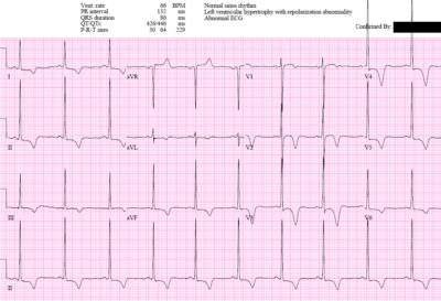 ST elevation in aVR, STEMI equivalent? | ECG Cases| Emergency Medicine ...