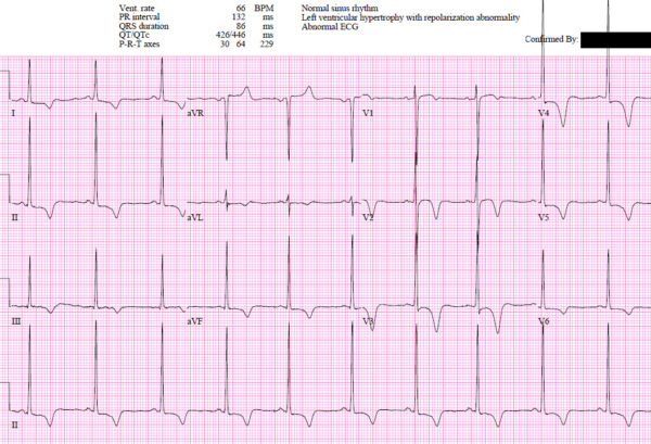 ST elevation in aVR, STEMI equivalent? | ECG Cases| Emergency Medicine Cases