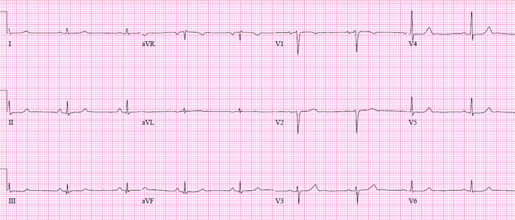 ST elevation in aVR, STEMI equivalent? | ECG Cases| Emergency Medicine ...