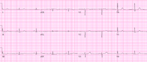 ST elevation in aVR, STEMI equivalent? | ECG Cases| Emergency Medicine ...