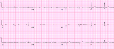 ST elevation in aVR, STEMI equivalent? | ECG Cases| Emergency Medicine ...