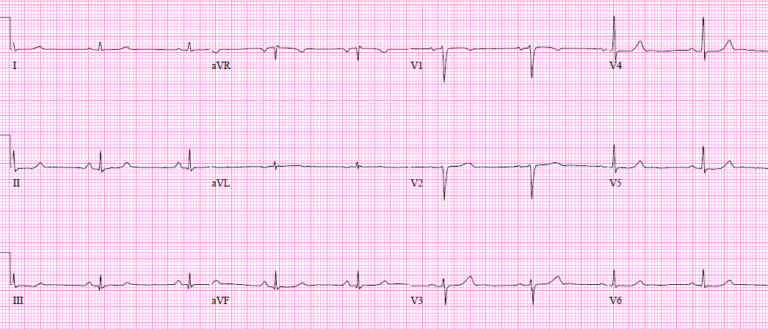 ST elevation in aVR, STEMI equivalent? | ECG Cases| Emergency Medicine ...