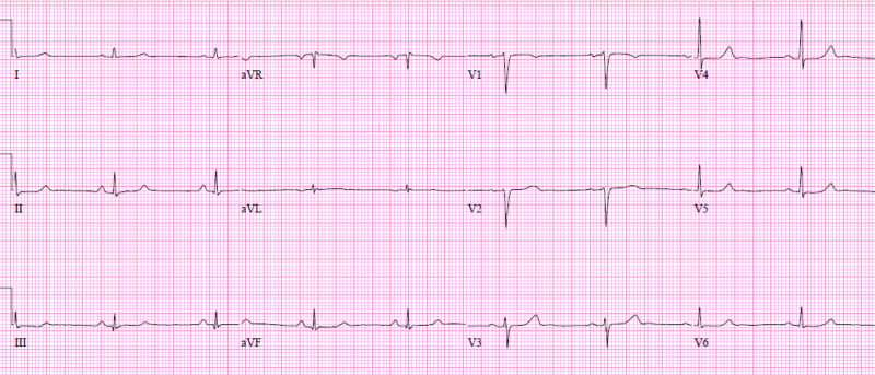 ST elevation in aVR, STEMI equivalent? | ECG Cases| Emergency Medicine ...