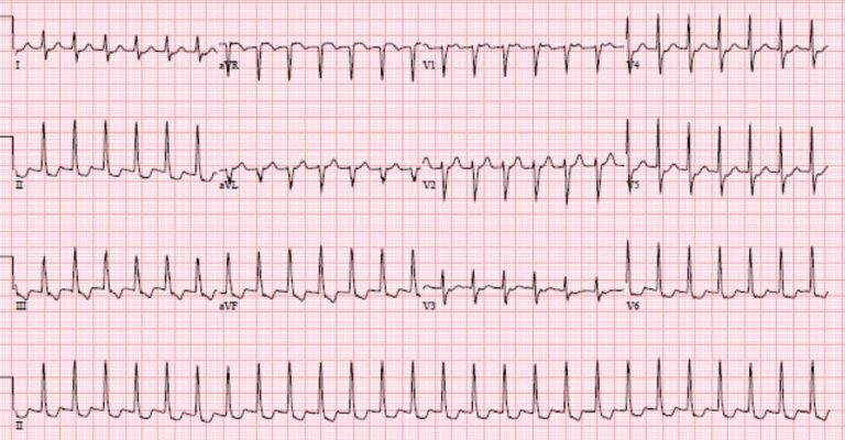 ST elevation in aVR, STEMI equivalent? | ECG Cases| Emergency Medicine ...