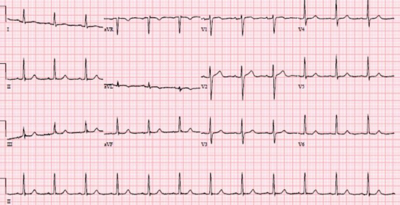 ST elevation in aVR, STEMI equivalent? | ECG Cases| Emergency Medicine ...
