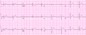 ST elevation in aVR, STEMI equivalent? | ECG Cases| Emergency Medicine ...