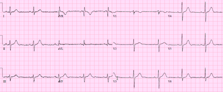 ST elevation in aVR, STEMI equivalent? | ECG Cases| Emergency Medicine ...