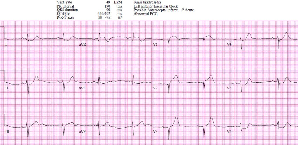 ST elevation in aVR, STEMI equivalent? | ECG Cases| Emergency Medicine ...
